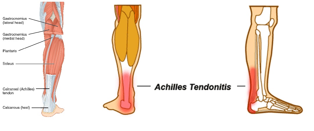Physical Therapy for Achilles Tendonitis - Specialized Physical Therapy